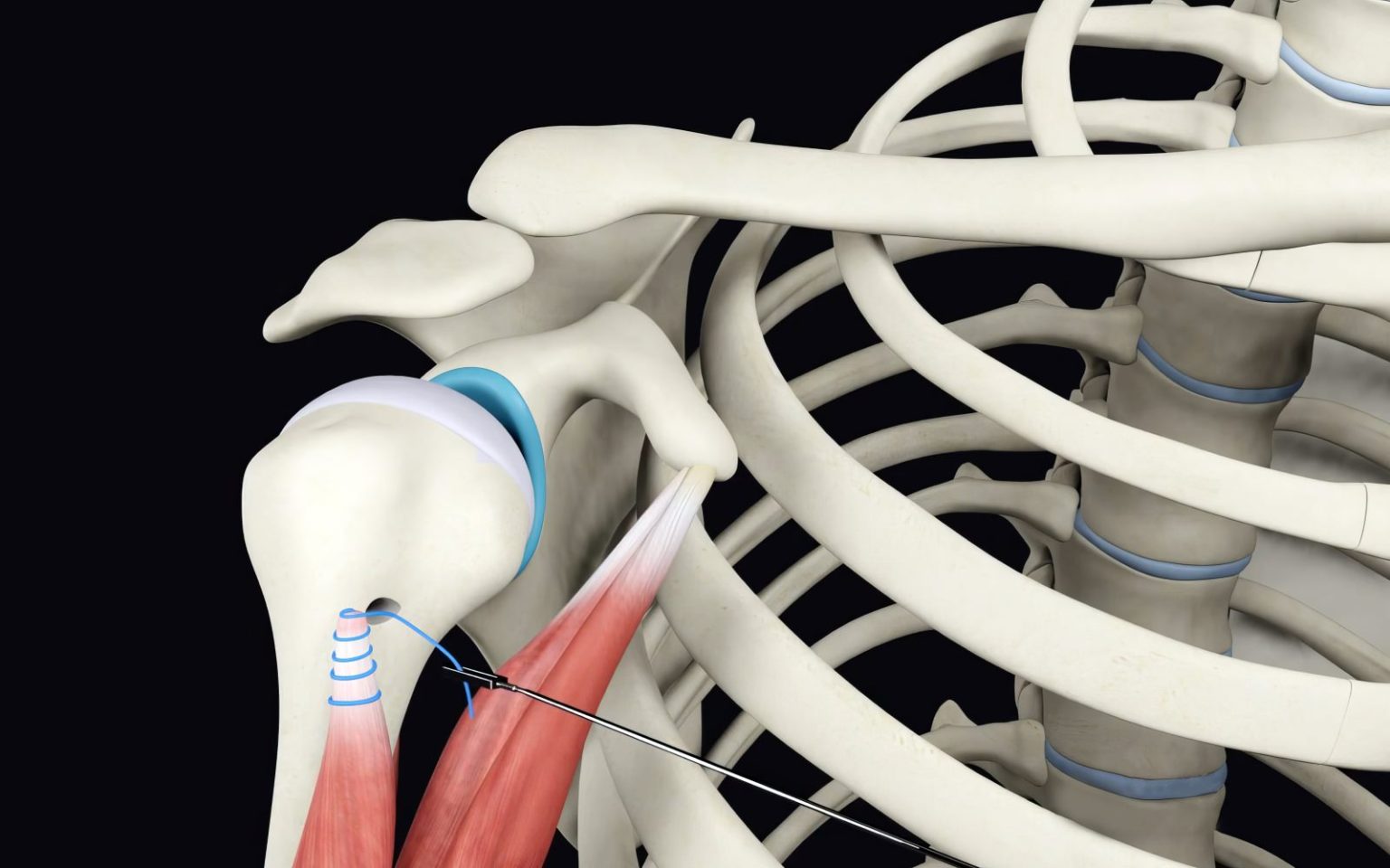 Ténotomie et ténodèse sub-pectoral longue portion du biceps | Dr Dani ...