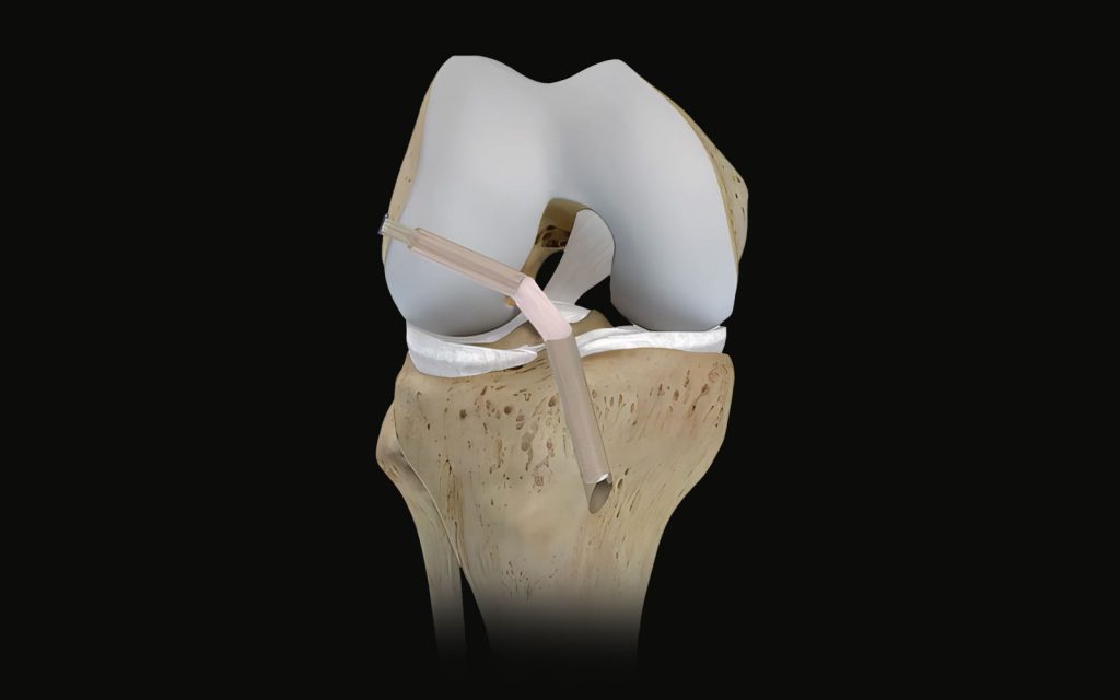Reconstruction du ligament croisé antérieur (LCA) par arthroscopie | Dr ...